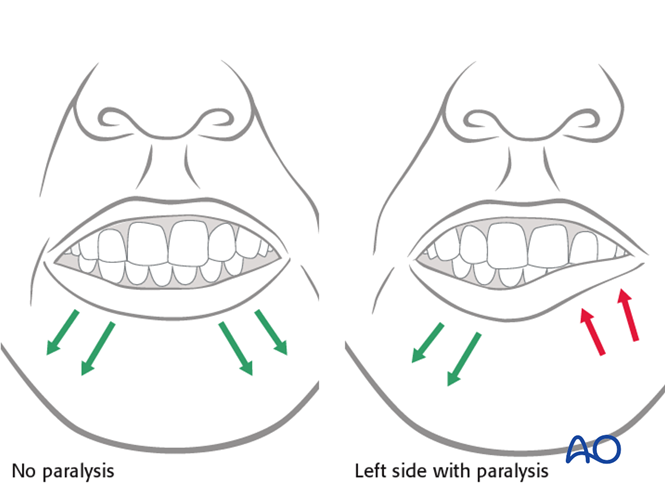 Contralateral depressor angularis muscle excision for Irreversible ...