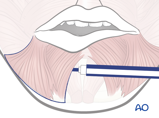 Contralateral depressor angularis muscle excision for Irreversible ...