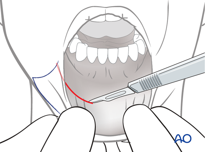 Contralateral depressor angularis muscle excision for Irreversible ...