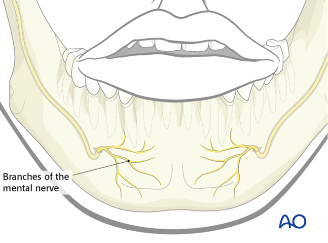 Contralateral depressor angularis muscle excision for Irreversible ...
