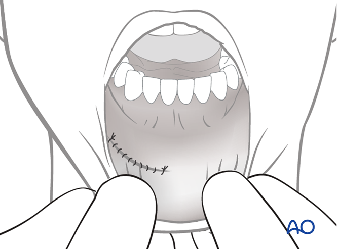 Contralateral depressor angularis muscle excision for Irreversible ...