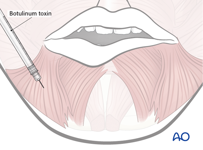 Contralateral depressor angularis muscle excision for Irreversible ...