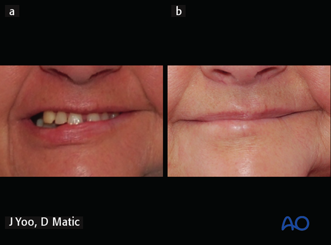 Contralateral depressor angularis muscle excision for Irreversible ...