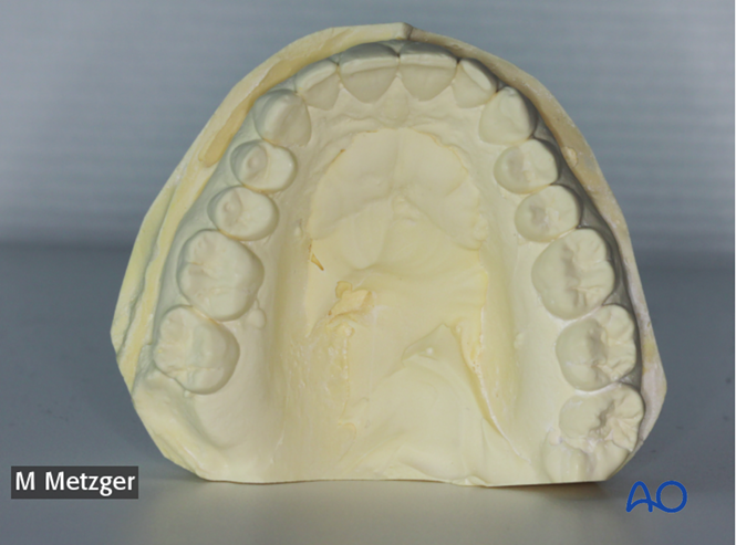 CAS: Asymmetry correction for Unilateral mandibular hypoplasia