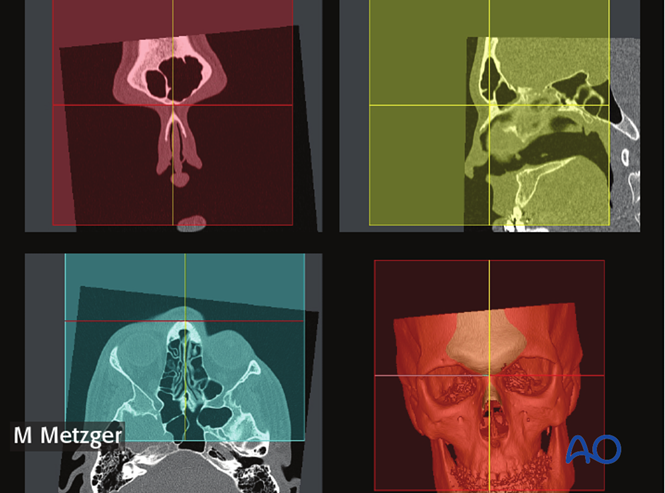 Bimaxillary correction