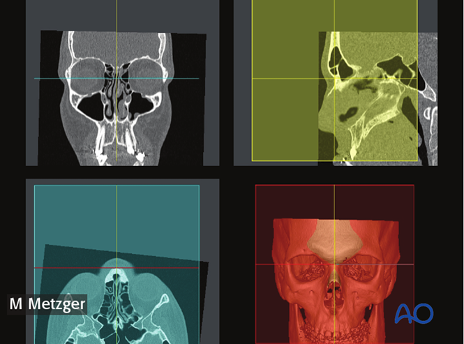 Bimaxillary correction