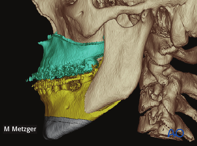 Bimaxillary correction