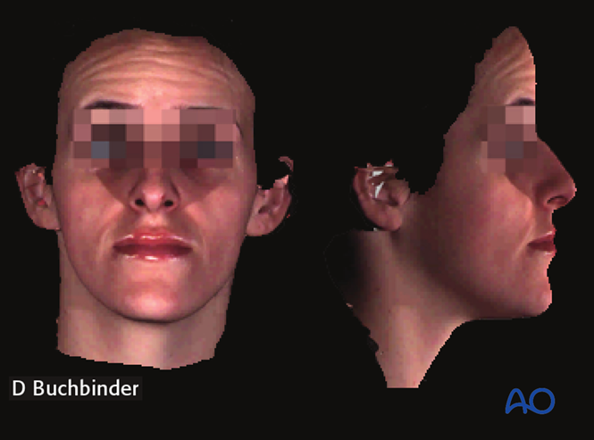 Bimaxillary correction