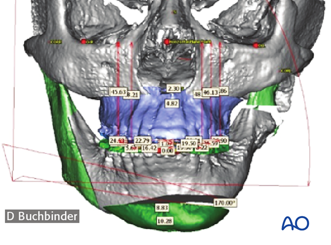 Bimaxillary correction