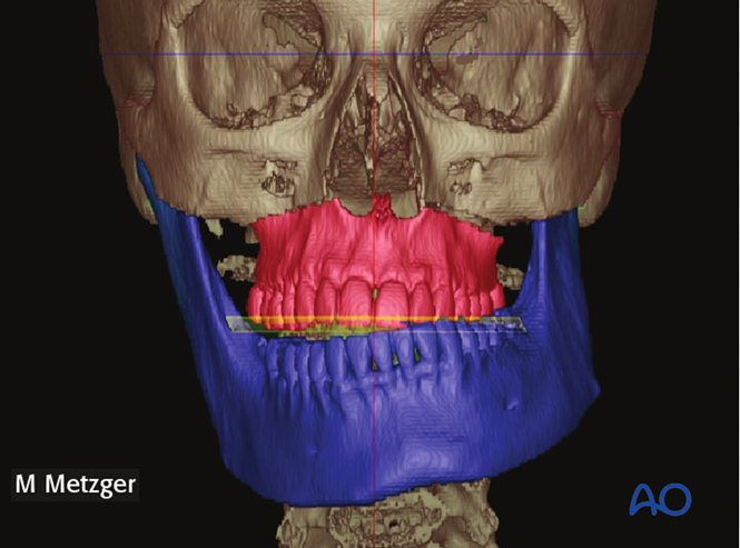CAS: Asymmetry correction for Unilateral mandibular hypoplasia