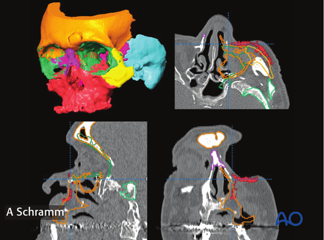 STL model, virtual planning, and intraoperative navigation