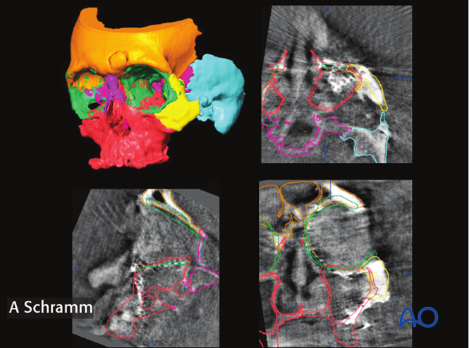 STL model, virtual planning, and intraoperative navigation