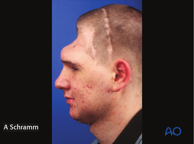 CAS: Cranioplasty for Frontal bone defects