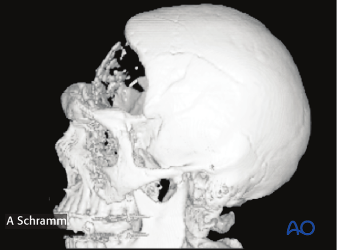 CAS: Cranioplasty for Frontal bone defects