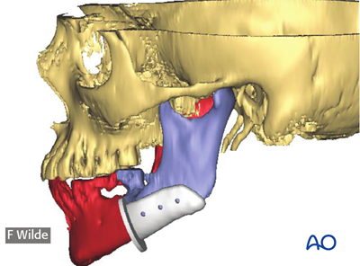 Mandibular reconstruction