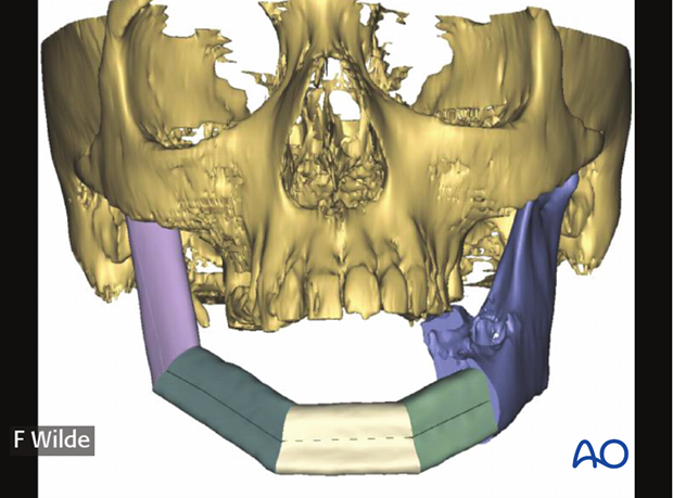 Mandibular reconstruction