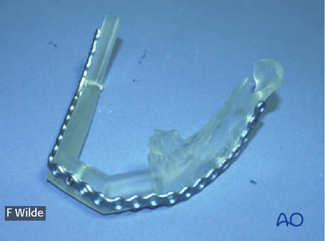 CAS: Mandibular reconstruction for Lateral mandible, mucosa and skin