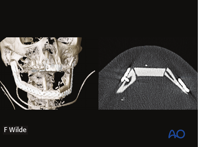 CAS: Mandibular reconstruction for Lateral mandible, mucosa and skin