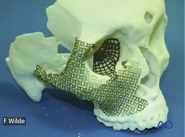 Virtual planning and intraoperative navigation