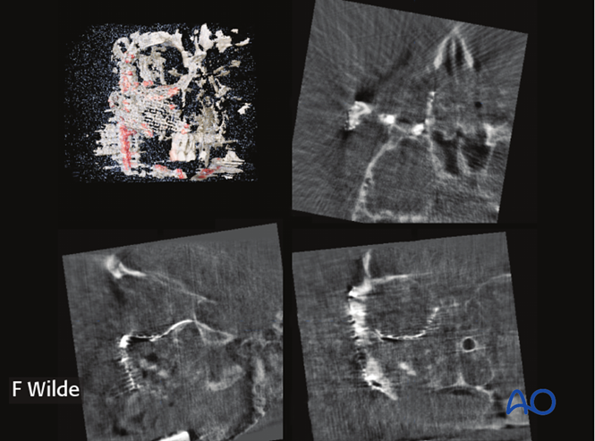 Virtual planning and intraoperative navigation