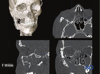 Virtual planning and intraoperative navigation