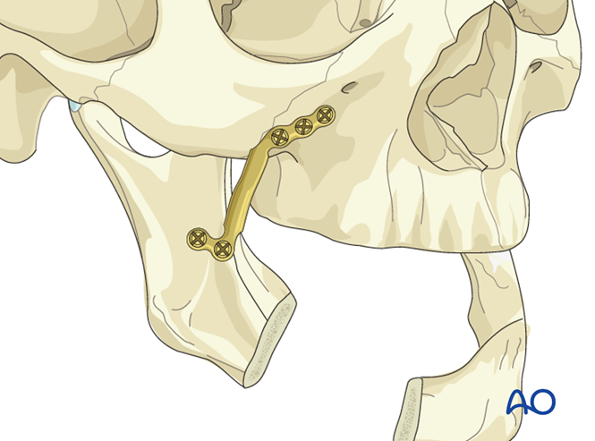 CAS: Prostodontic-driven mandibular reconstruction for Lateral mandible ...