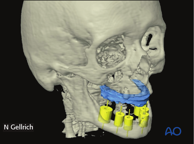 CAS: Prostodontic-driven mandibular reconstruction for Lateral mandible ...