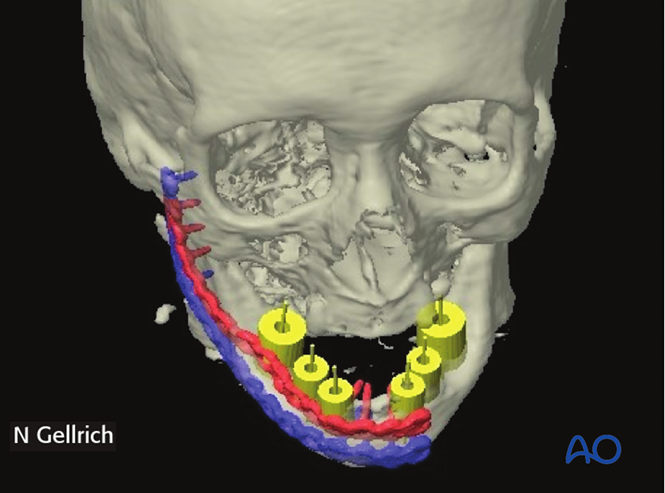 Prostodontic-driven mandibular reconstruction