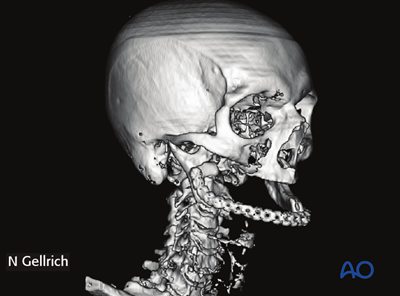 Prostodontic-driven mandibular reconstruction