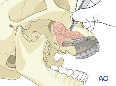 CAS: Prostodontic-driven maxillary reconstruction for Brown III