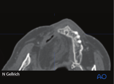 CAS: Prostodontic-driven maxillary reconstruction for Brown III