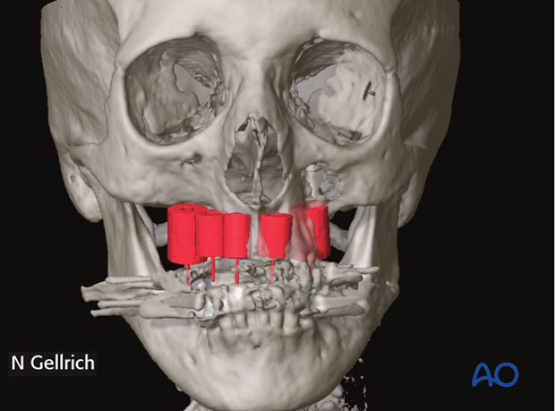 CAS: Prostodontic-driven maxillary reconstruction for Brown III