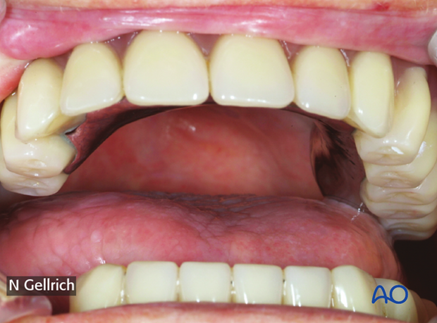 CAS: Prostodontic-driven maxillary reconstruction for Brown III