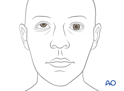 Midface reconstruction