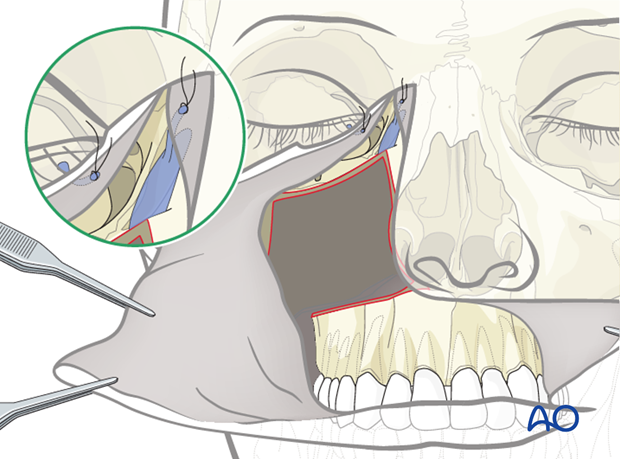 Midface reconstruction