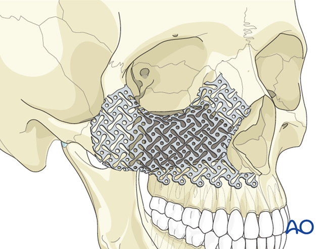 Midface reconstruction