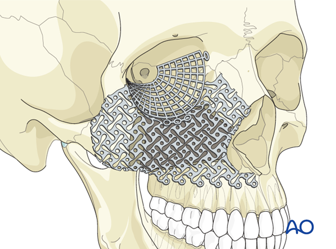 Midface reconstruction