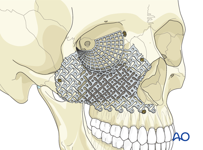 Midface reconstruction