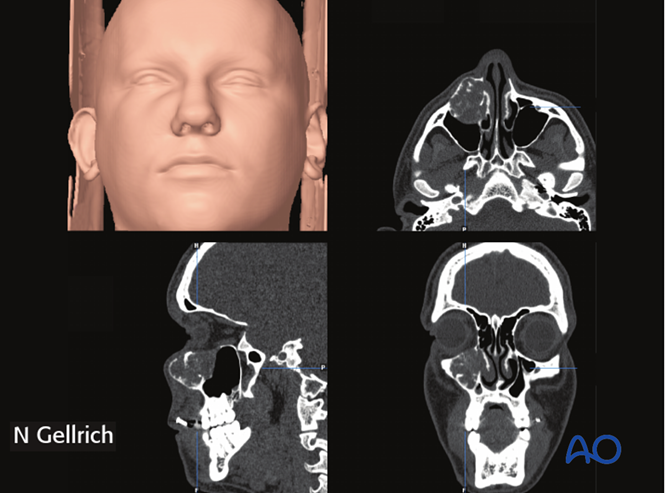 Midface reconstruction
