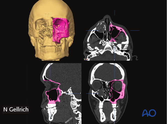 Midface reconstruction