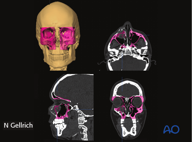 Midface reconstruction