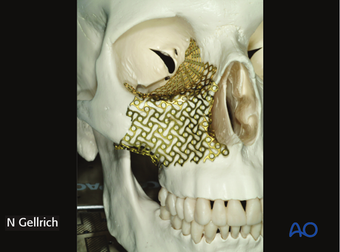 Midface reconstruction