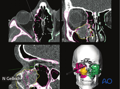Midface reconstruction