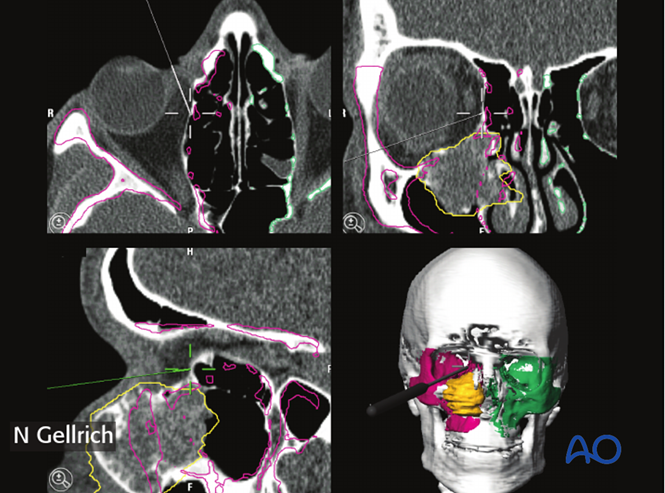 Midface reconstruction