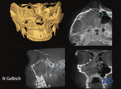 Midface reconstruction