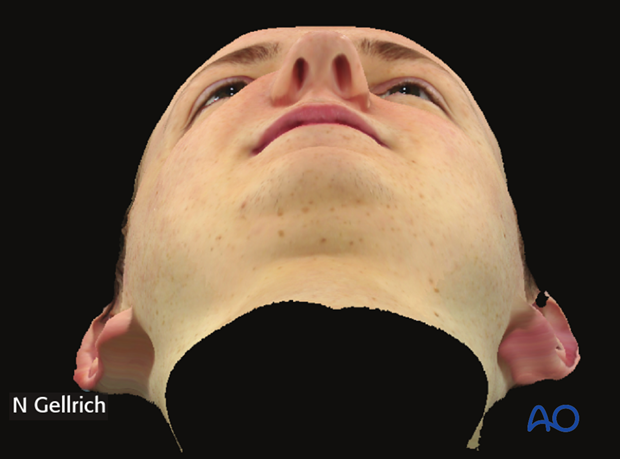 Midface reconstruction