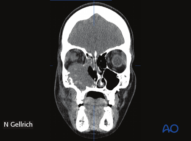 Midface reconstruction