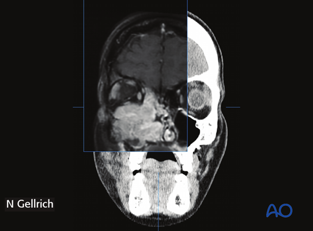 Midface reconstruction
