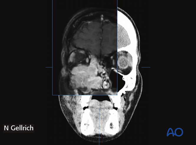 Midface reconstruction