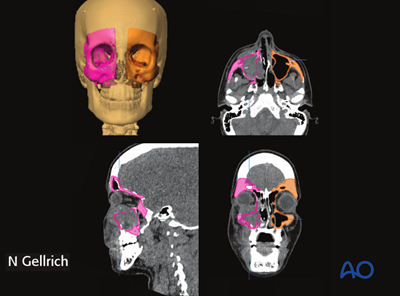 Midface reconstruction